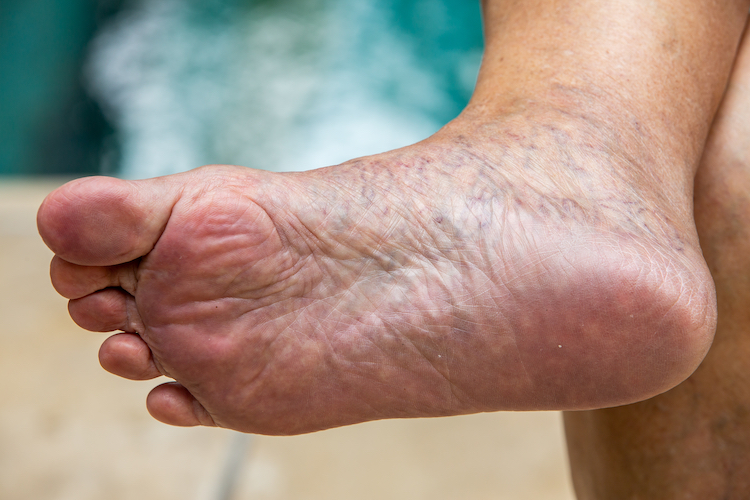 Známka zvýšeného cholesterolu: Pečlivě si prohlédněte ruce a nohy